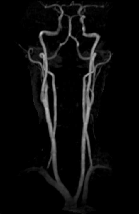 Plan Mra Neck Tof 3d Mip Mrimaster