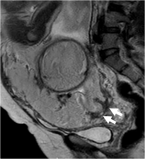 Mr Imaging Of Placenta Accreta Spectrum Magnetic Resonance Imaging