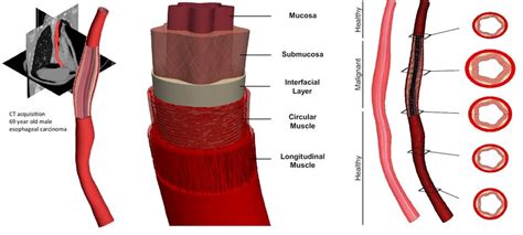 Patientspecific Esophagus Model A Segmentation Of The Download