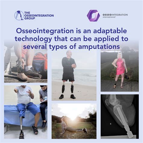 Osseointegration Group