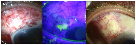 Management Of Steroid Induced Glaucoma In A Patient With Pyoderma