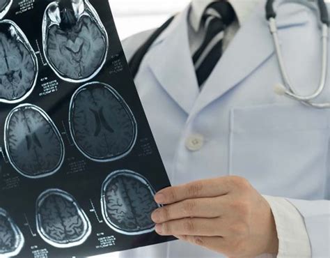 Stroke Screening In Singapore