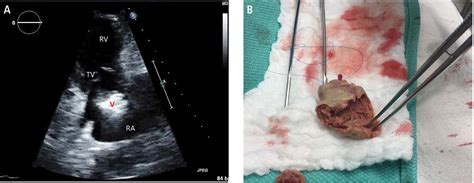 Cardiac Implantable Electronic Device Infection Mdedge