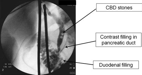 Pancreatic Duct Filling During Cholecystectomy Intraoperative