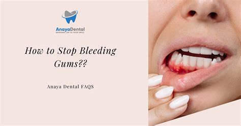 How To Stop Bleeding Gums Anaya Dental