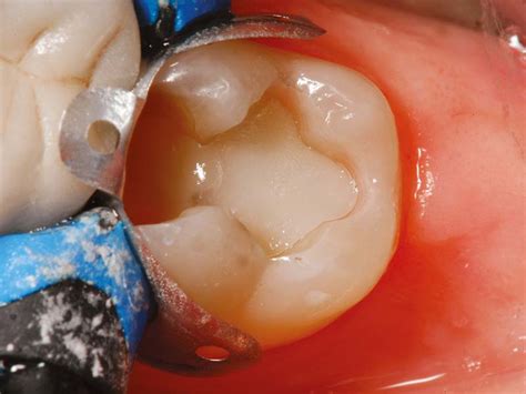 Activa™ Bioactive Baseliner™ Pulpdent