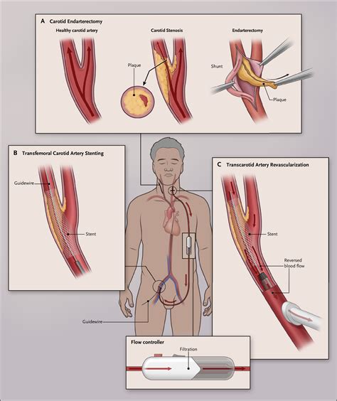 What Is The Role Of Transcarotid Artery Revascularization In The Treatment Of Carotid Stenosis