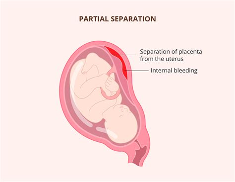 What Can You Do For Placental Abruption At Stephanie Daley Blog