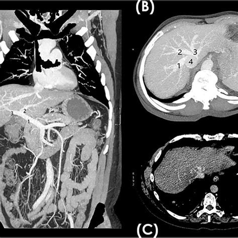 Abdominal Ct Hypertrophy Of The Left Hepatic Lobe The Gallbladder Is
