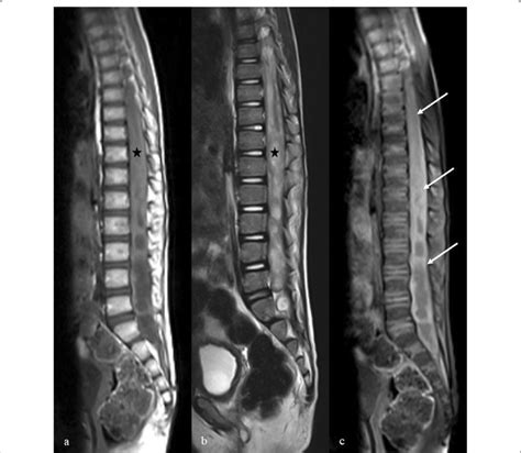 Sagittal T1 A T2 B And T1 Post Contrast C Sequences Show Long Download Scientific