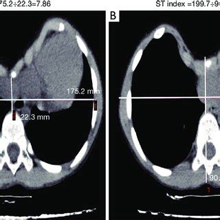 Definition Of The Computed Tomography CT Index And Surface Topography Download Scientific