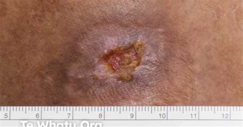 Pyoderma Gangrenosum Image