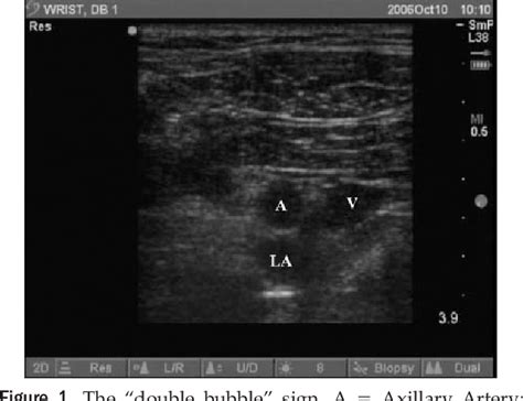 Figure 1 From A Comparison Between Ultrasound Guided Infraclavicular Block Using The “double
