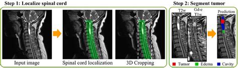 Fully Automatic Spinal Cord Tumor Segmentation Framework Step 1 The Download Scientific
