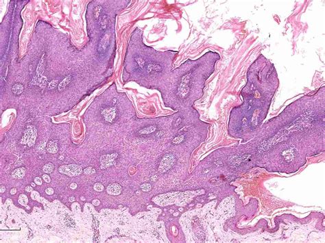 皮肤乳头状瘤 皮肤乳头状瘤 Pathology Images Database