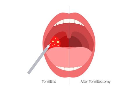 Tonsillectomy Procedure Poster Premium Vector