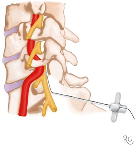 Artistic Illustration Of The Focused C7 Nerve Root Steroid Injection Download Scientific