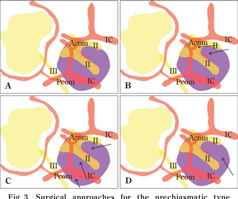 Figure 3 From Surgical Strategy For Craniopharyngiomas Based On Anatomical Classification