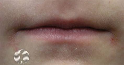 Angular Cheilitis Image