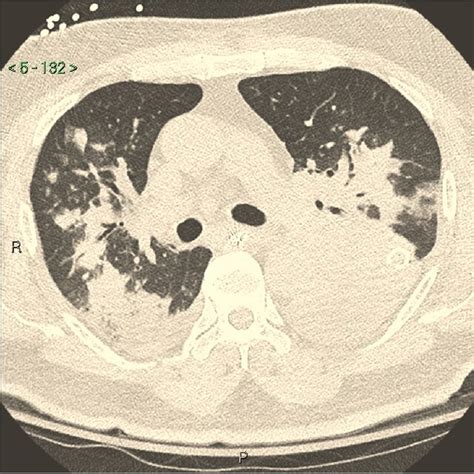 Non Contrast Enhanced Computed Tomography Of The Chest Patient 1 Download Scientific Diagram