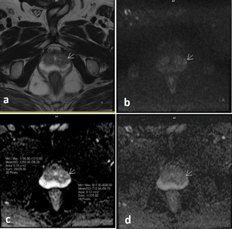 A 55 Year Old Male Patient Whose Serum Psa Level Was 56 Ngml A On Download Scientific
