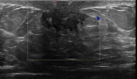 Gynecomastia Pacs