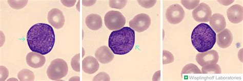 L1 Lymphoblast