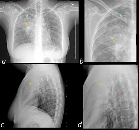 Atelectasis Pictures Atelectasis Imaging Practice Essentials