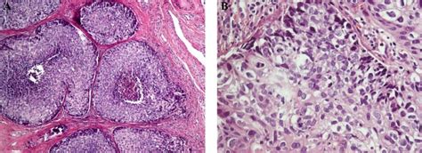 A Poorly Differentiated Extraocular Sebaceous Carcinoma With Comedo