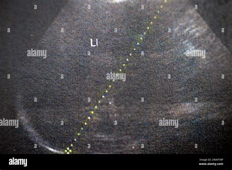 The Liver Is Average In Size 15 Cm With Homogeneous Echogenicity No