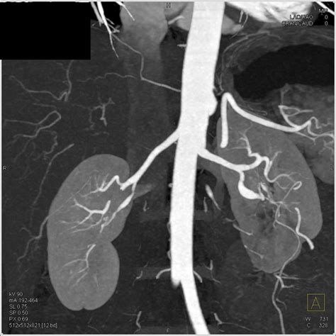 Vasculitis Involving The Renal Arteries Vascular Radiology Case