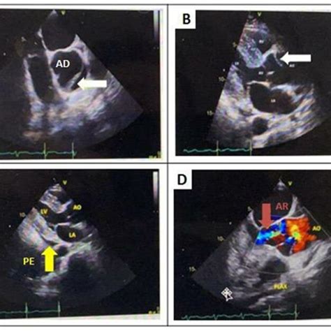 A D Echocardiographic Views Revealed A Suspicion Of A Flap At The