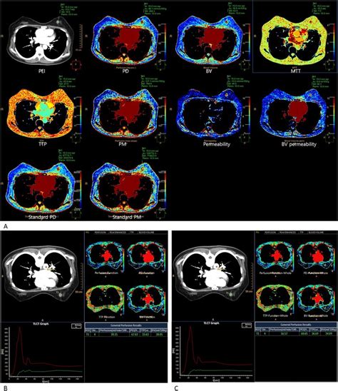 Evaluated 18 Hemodynamic Parameters On Low Dose Breast Perfusion Ct