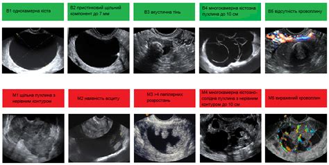 Кіста яєчника що робити