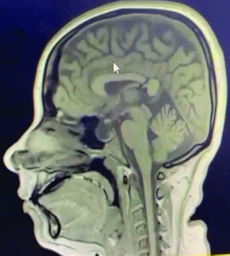 Postoperative Magnetic Resonance Imaging Brain Sagittal Cut Tip Of