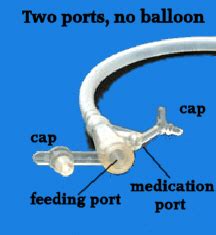 The Procedure Options For Feeding Tube Placement