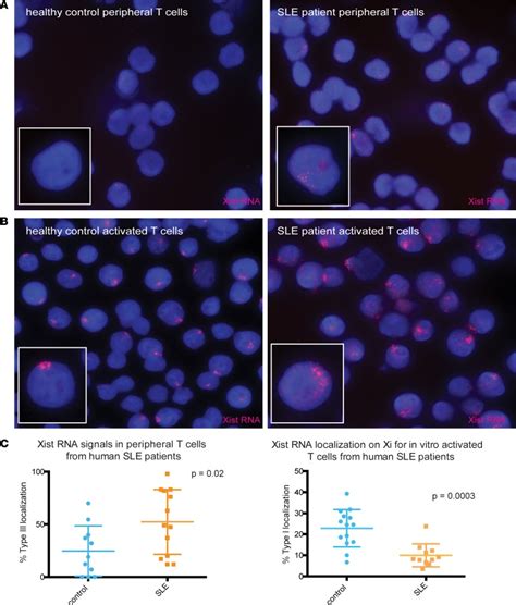 Altered X Chromosome Inactivation In T Cells May Promote Sex Biased Autoimmune Diseases Pmc