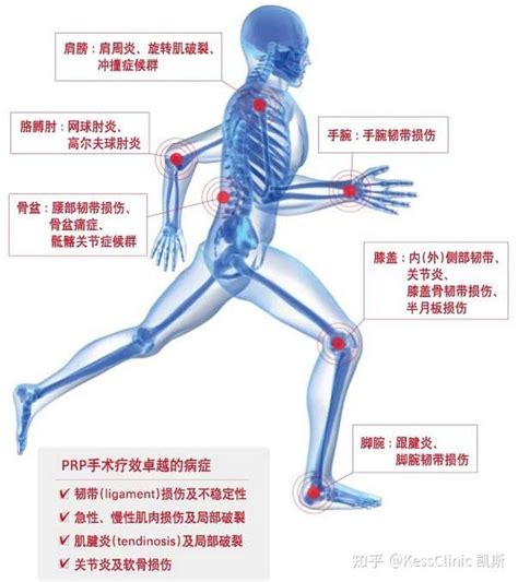 省医专家联合会诊 治愈坐骨结节滑囊炎 知乎