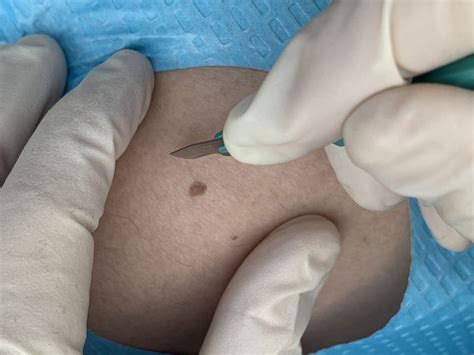 Excision And Excision Biopsy Spot Check Skin Cancer Aesthetics Melbourne