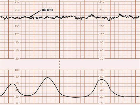 16 1 Basic Terms Of Fetal Heart Rate And Contraction Patterns