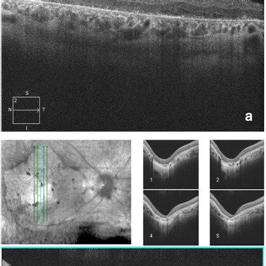 Representative OCT A OCT Of Macular Area In The Left Eye Of Patient Download Scientific