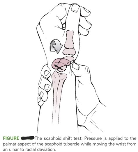 Important Orthopedic Topics Scaphoid Fracture