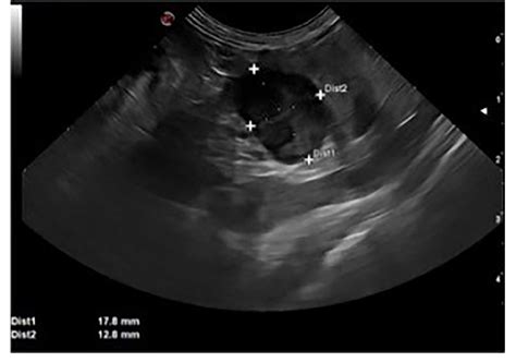 Abdominal Ultrasound Showing A Heterogeneous Nodular Structure Download Scientific Diagram