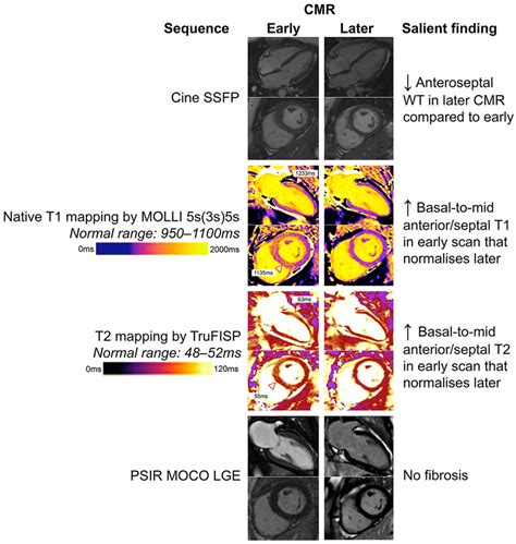 Comparing Salient Findings Between The Early Cmr Scan Performed 2 Days Download Scientific