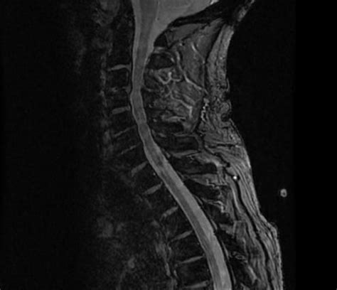Incomplete Spinal Cord Injuries Spine Orthobullets
