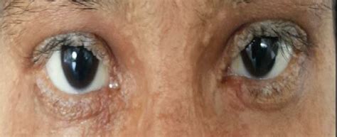 Patient Showing Complete Loss Of Lower Eye Figure 2 Multiple Nodules