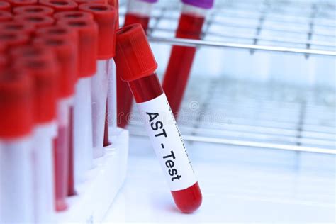 AST Test To Look For Abnormalities From Blood Stock Image Image Of Anemia Experiment 264508437