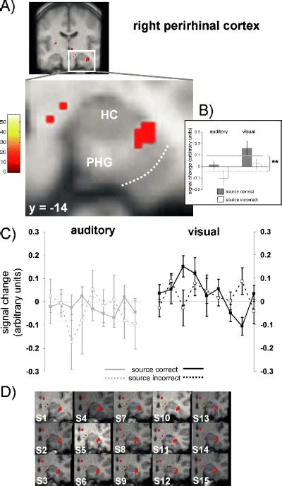 A Perirhinal Cortex Activation In The Contrast Correct Vs Incorrect Download Scientific