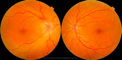 Espacio Retina Papilitis