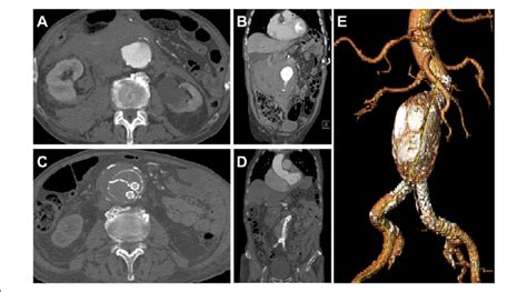 A Axial And B Coronal Slices Of A Contrast Enhanced Computed Download Scientific Diagram